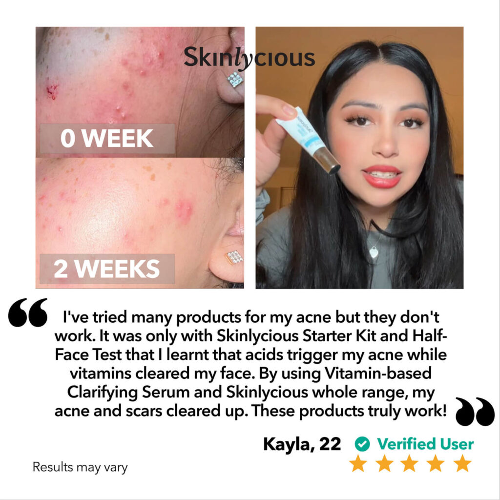 Best Gentle Pimple and Acne Treatment Gel. No peeling. No dryness.